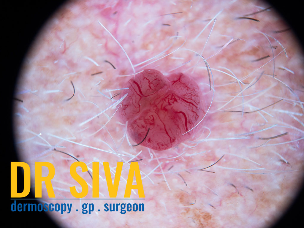 Basal Cell Cancer - DrSiva.co.nz